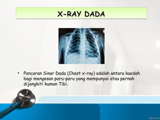 Penyakit tuberkulosis @ tibi dani | PPT