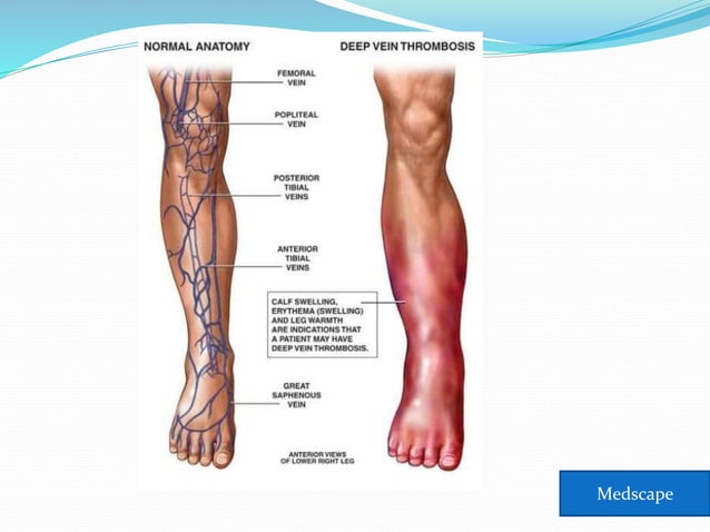 Penyakit vascular | PPTX