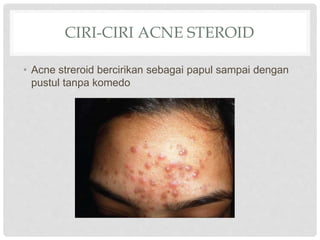 Penyebab jerawat pada wajah | PPTX