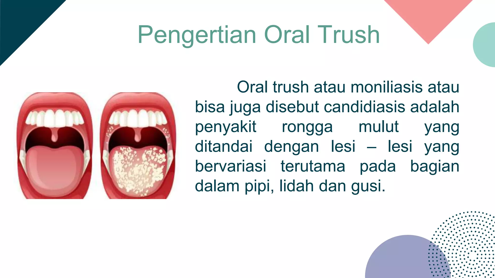 Penyulit dan Komplikasi Neonatus, bayi diaper rush, seborhea & oral ...