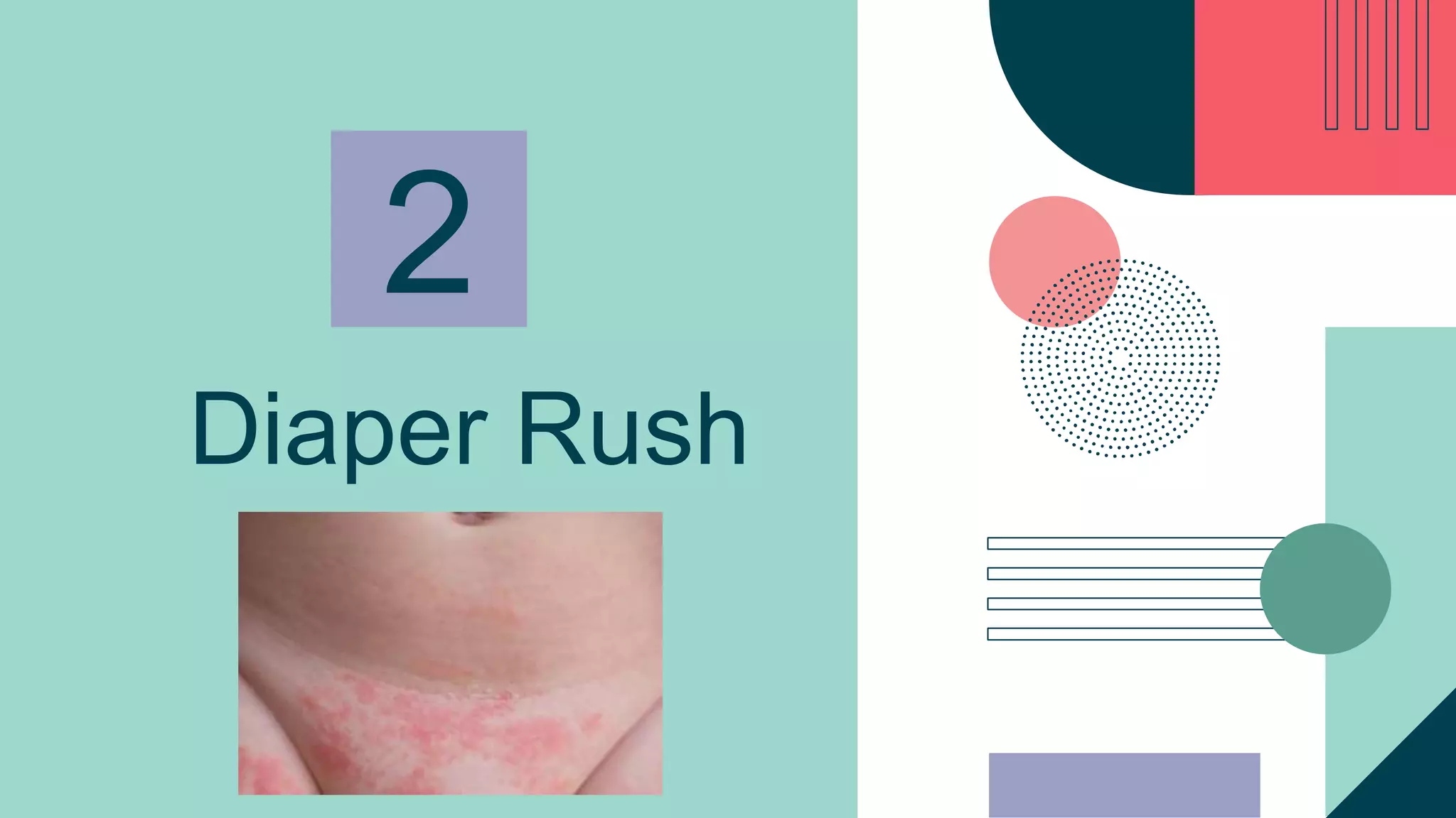 Penyulit dan Komplikasi Neonatus, bayi diaper rush, seborhea & oral trush.pptx