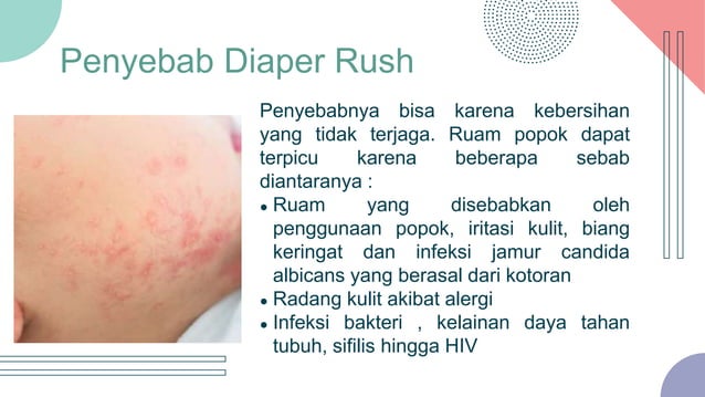 Penyulit dan Komplikasi Neonatus, bayi diaper rush, seborhea & oral trush.pptx