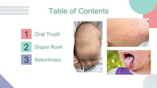Penyulit dan Komplikasi Neonatus, bayi diaper rush, seborhea & oral trush.pptx