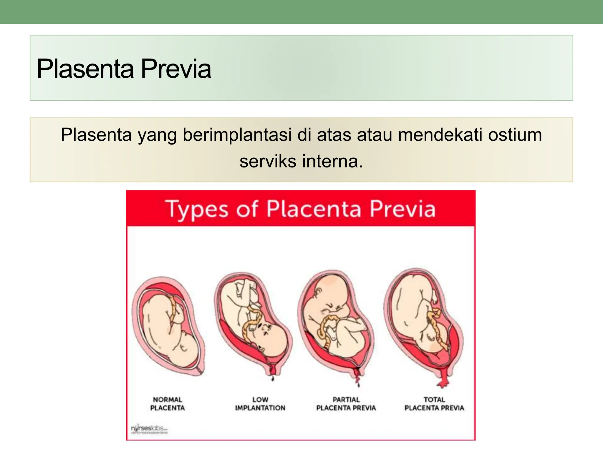 Tata laksana kehamilan dan persalinan dengan penyulit obstetri | PPT