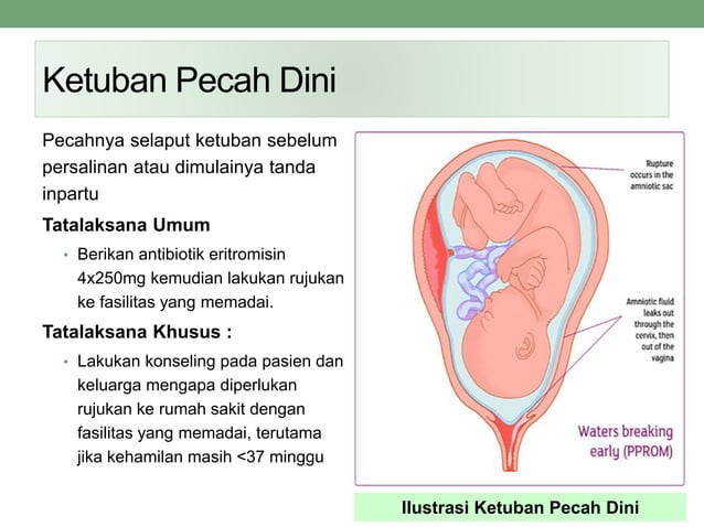 Tata laksana kehamilan dan persalinan dengan penyulit obstetri | PPT