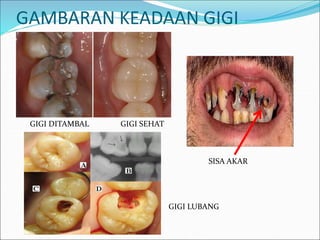 penyuluhan-gigi.ppt