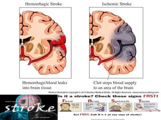 PENYULUHAN-STROKE-PROLANIS, penyakit tidak menular.ppt