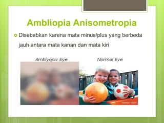 ambliopia | PPTX
