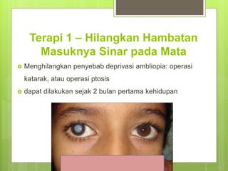 ambliopia | PPTX