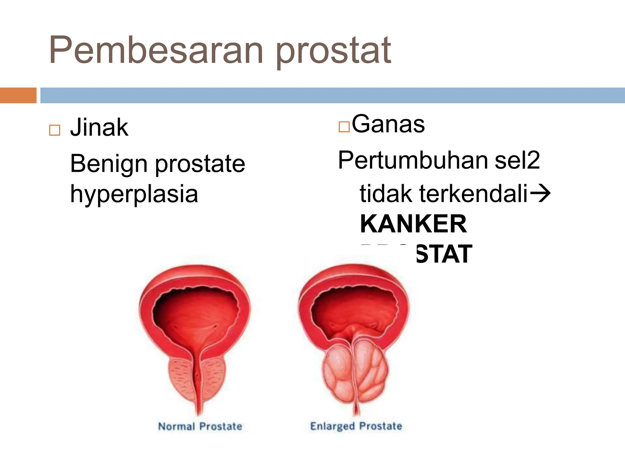 penyuluhan edukasi kanker prostat untuk masyarakat awam | PPTX