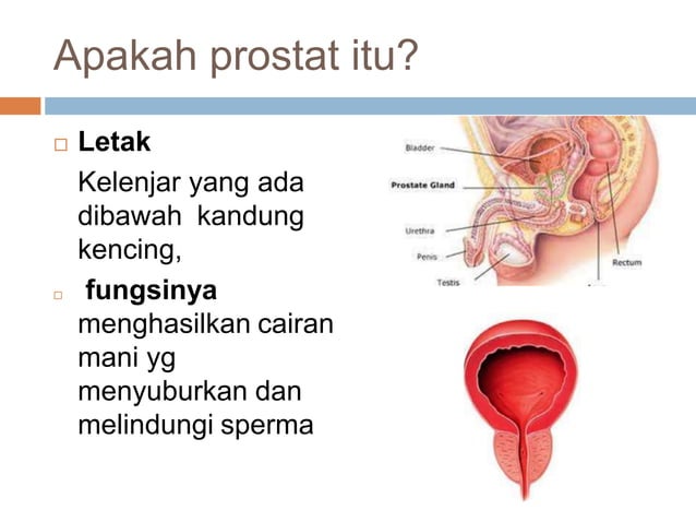 penyuluhan edukasi kanker prostat untuk masyarakat awam | PPTX
