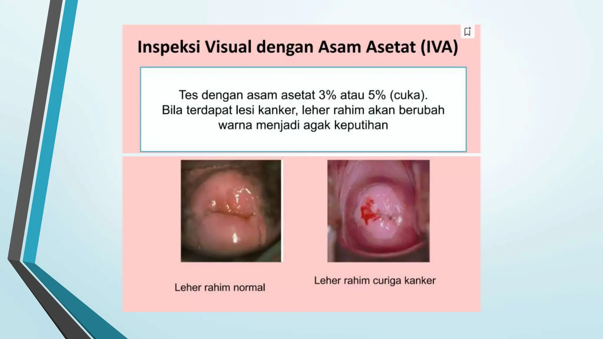 Penyuluhan Ca Servix dan pemeriksaan IVA | PPTX