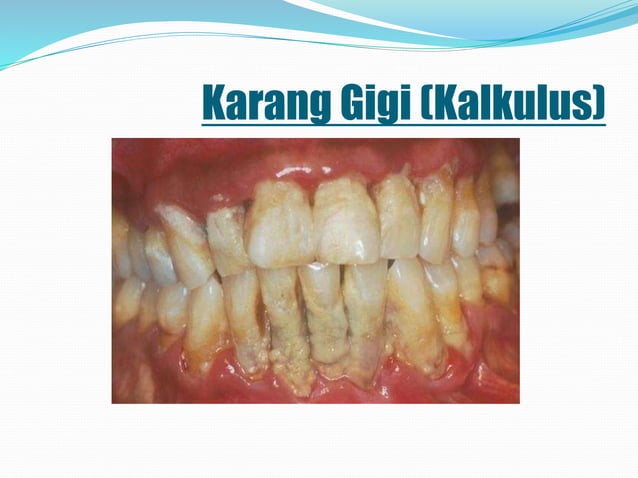 penyuluhan gigi dan mulut untuk sekolah.pptx