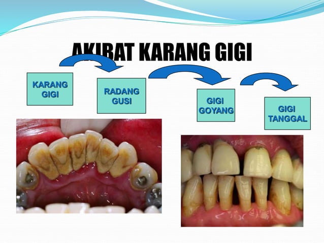penyuluhan gigi dan mulut untuk sekolah.pptx