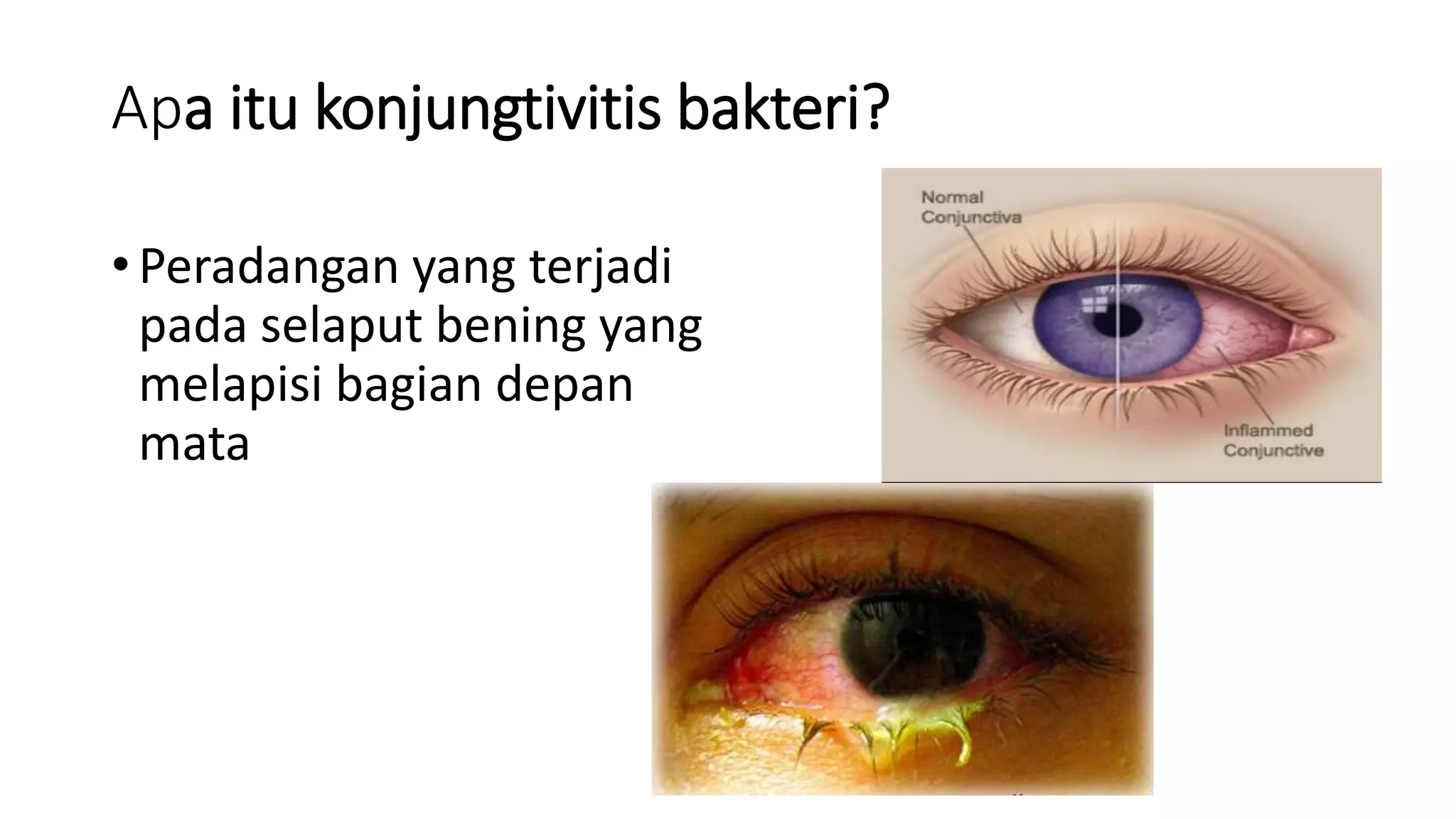 penyuluhan konjungtivitis bakterialis revisi 3.pptx