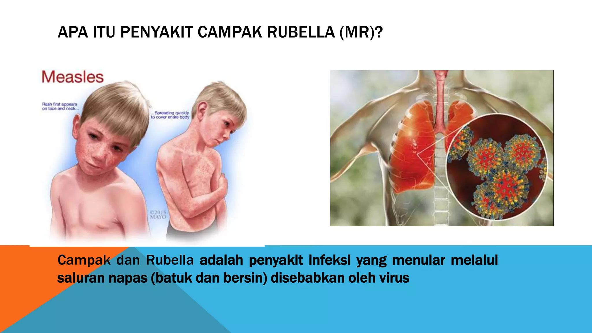 Penyuluhan Measles dan Rubella | PPTX