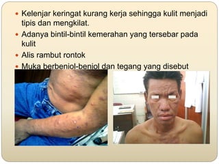Penyuluhan_Penyakit_Kusta_1.pptx