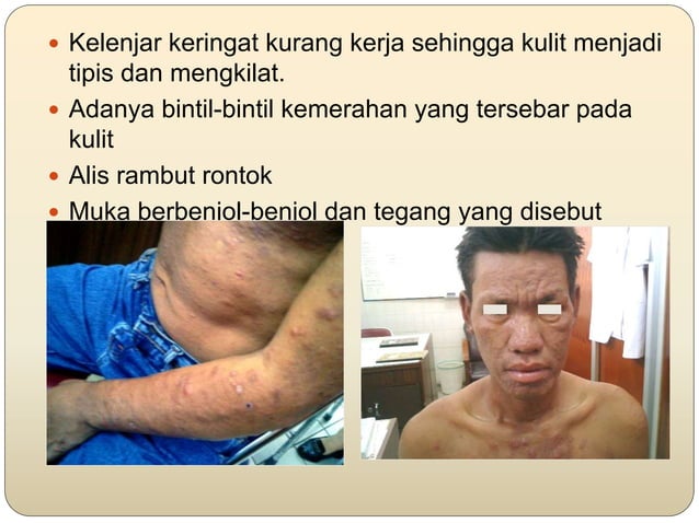 Penyuluhan_Penyakit_Kusta_1.pptx