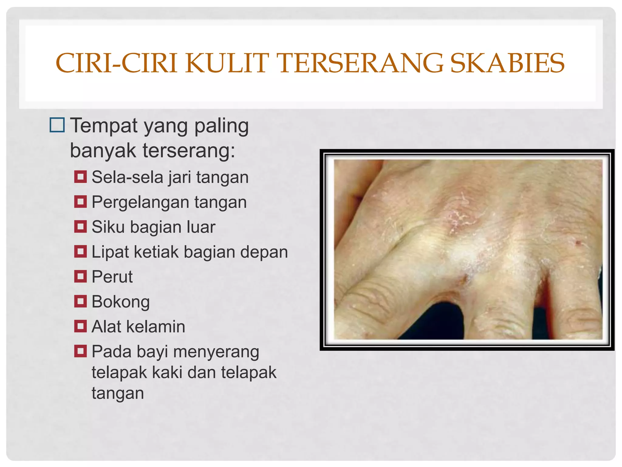Penyuluhan Scabies.ppt