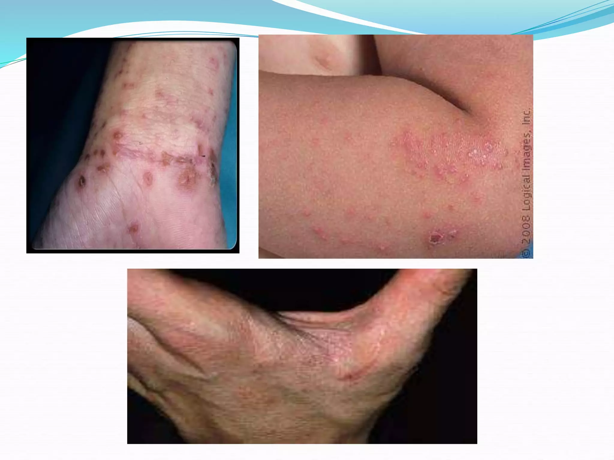 Penyuluhan_Scabies_Ppt.ppt