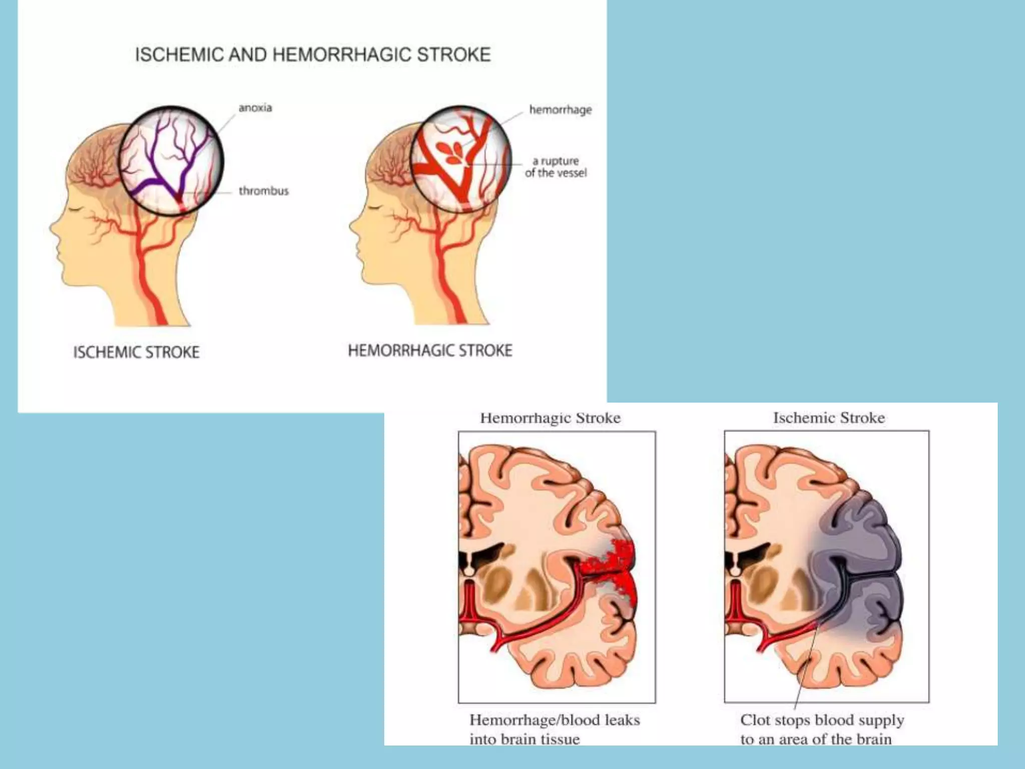 Penyuluhan_Stroke.pptx