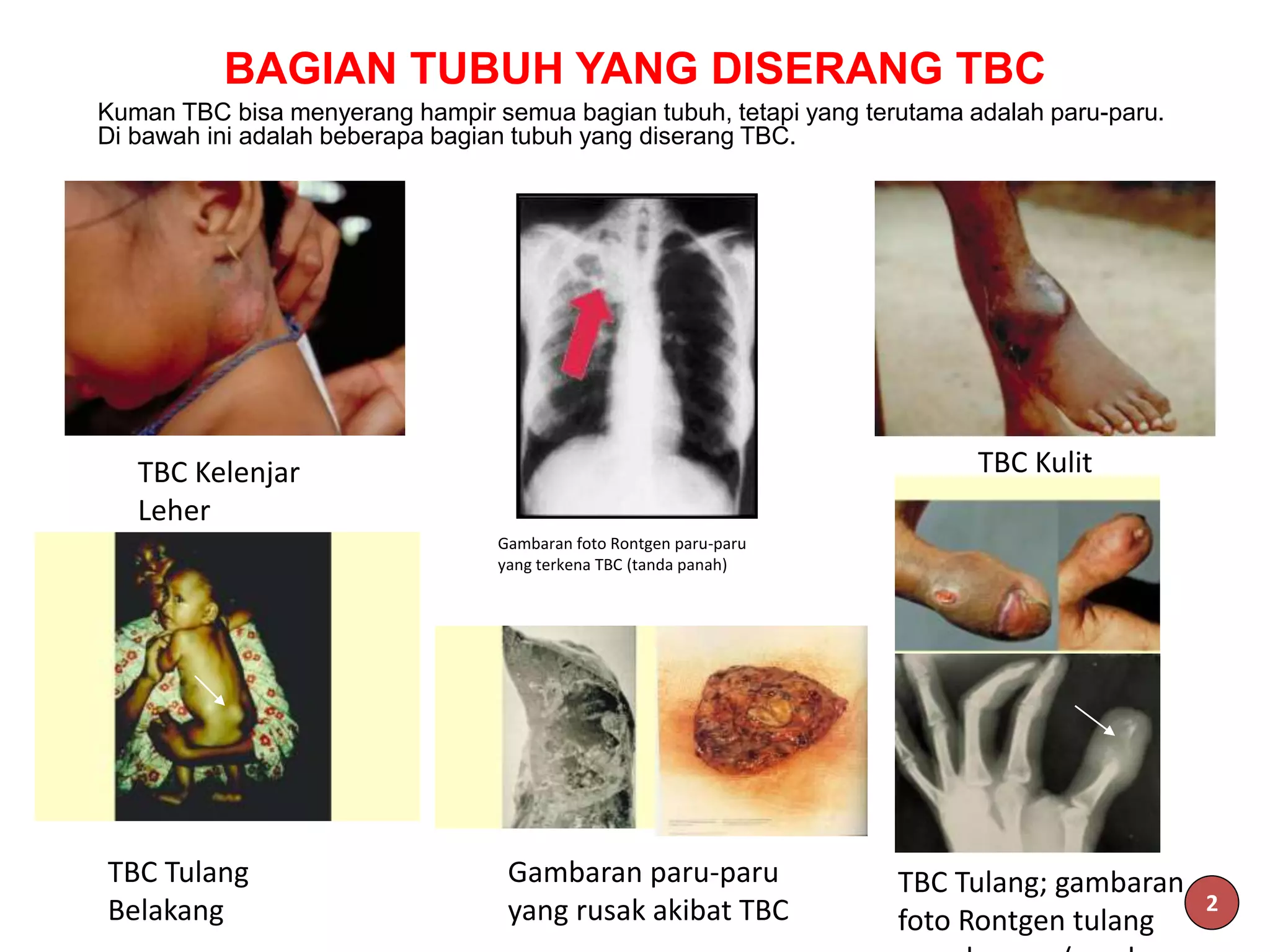 Penyuluhan_TB_pd_masyarakat (1).ppt