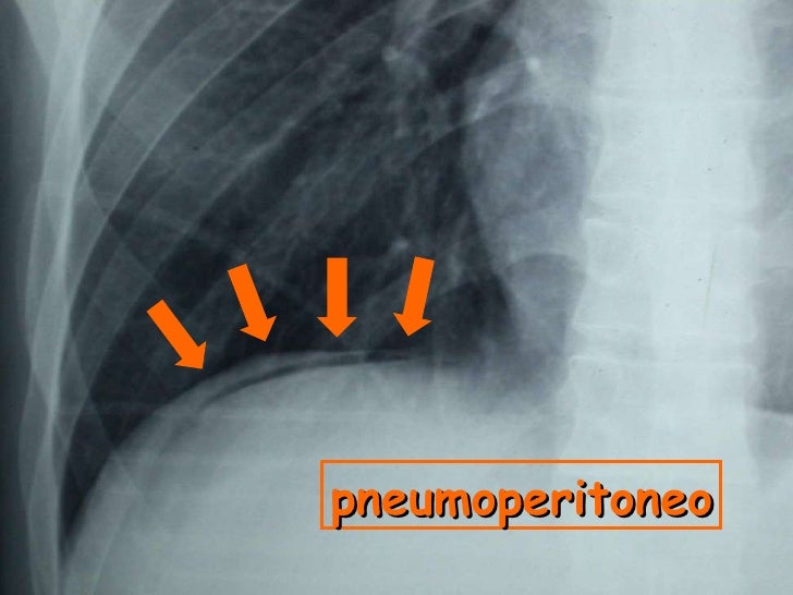 Pepe sub-occlusione intestinale e coprostasi