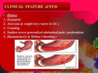 Pepic ulcer | PPTX