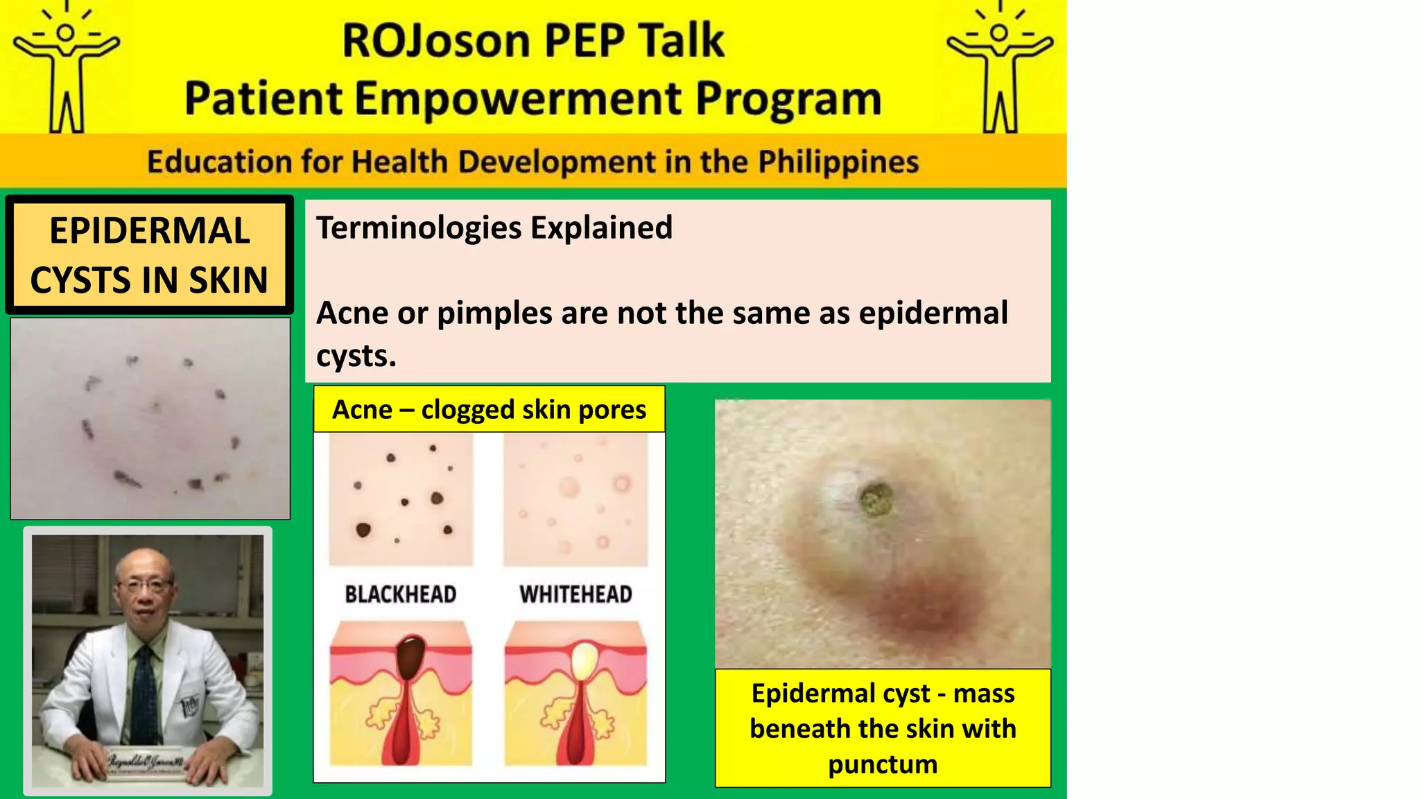 ROJoson PEP Talk: Epidermal Cysts in Skin | PPTX