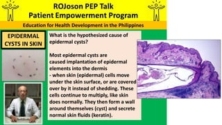 ROJoson PEP Talk: Epidermal Cysts in Skin | PPTX