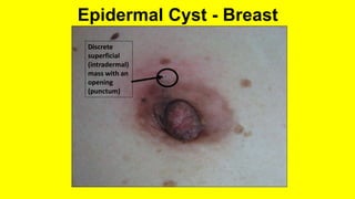 ROJoson PEP Talk: Epidermal Cysts in Skin | PPTX