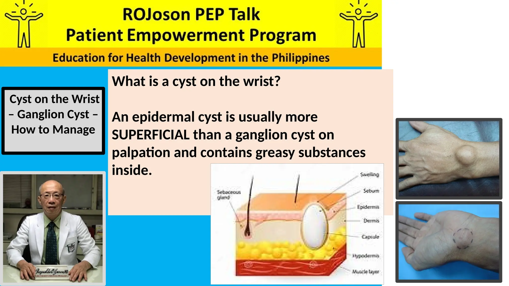 Cyst on the Wrist – Ganglion Cyst – How to Manage | PPTX