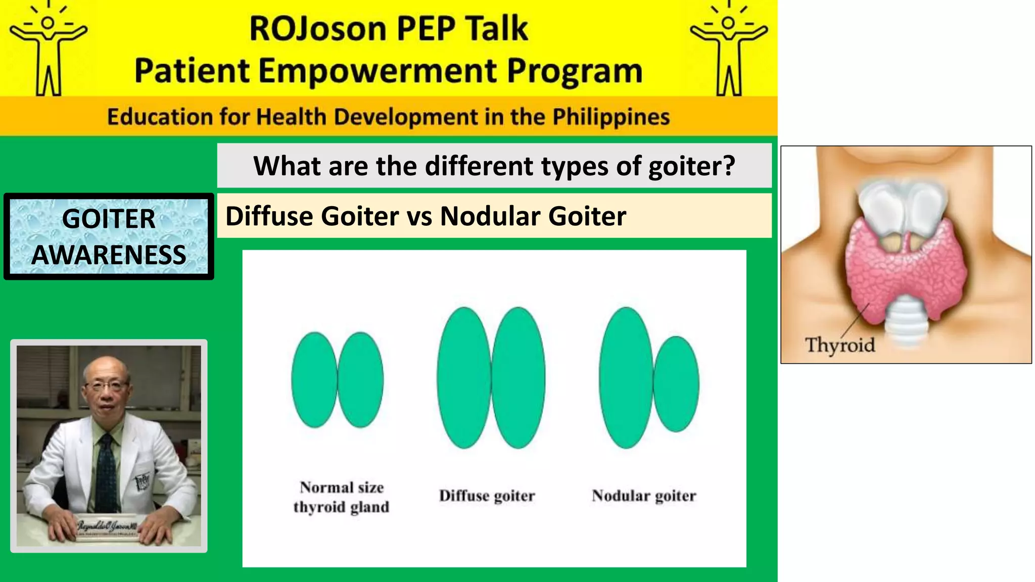 ROJoson PEP Talk: GOITER AWARENESS | PPTX