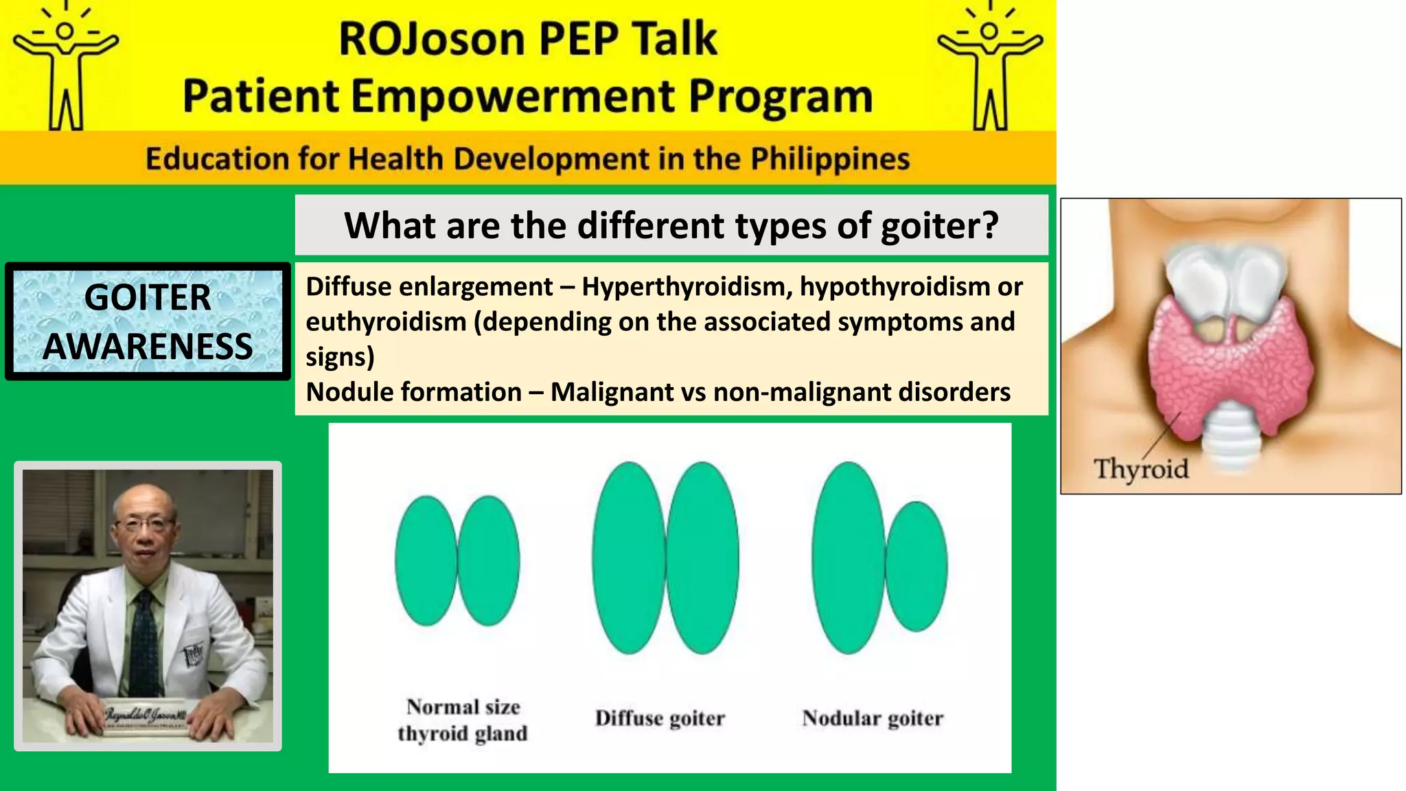 ROJoson PEP Talk: GOITER AWARENESS | PPTX