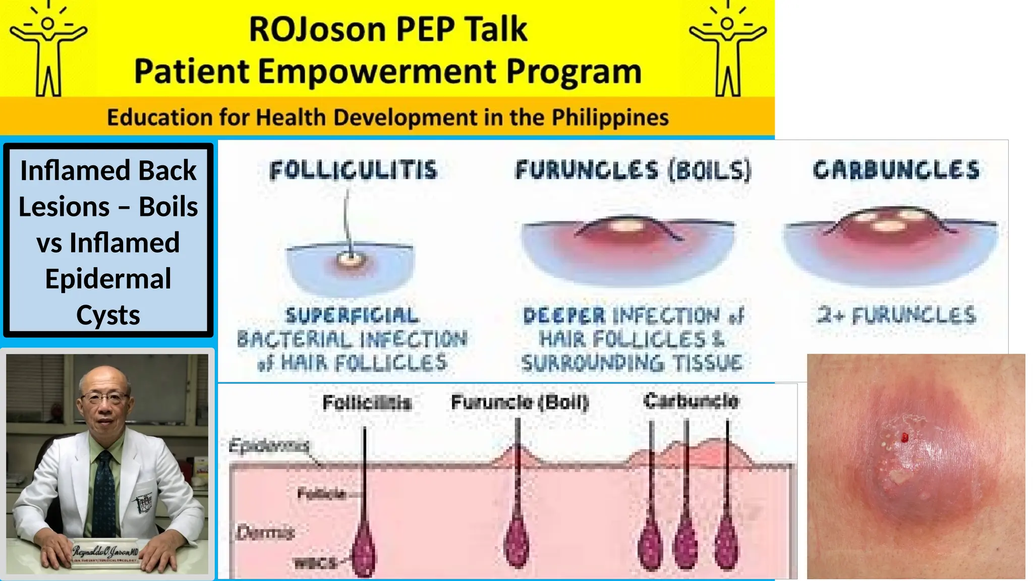ROJoson PEP Talk: Inflamed Back Lesions: Boils vs Inflamed Epidermal ...