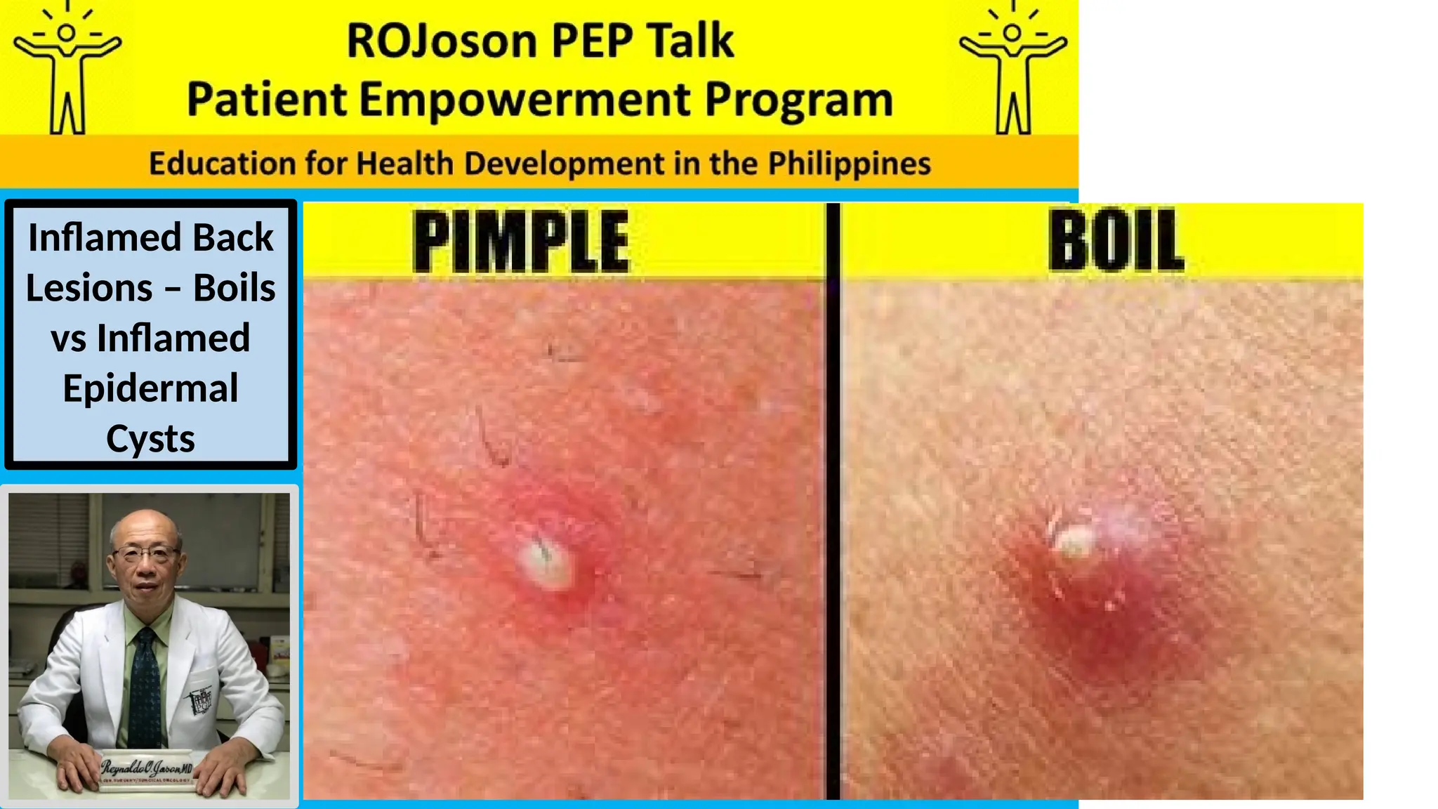 ROJoson PEP Talk: Inflamed Back Lesions: Boils vs Inflamed Epidermal ...