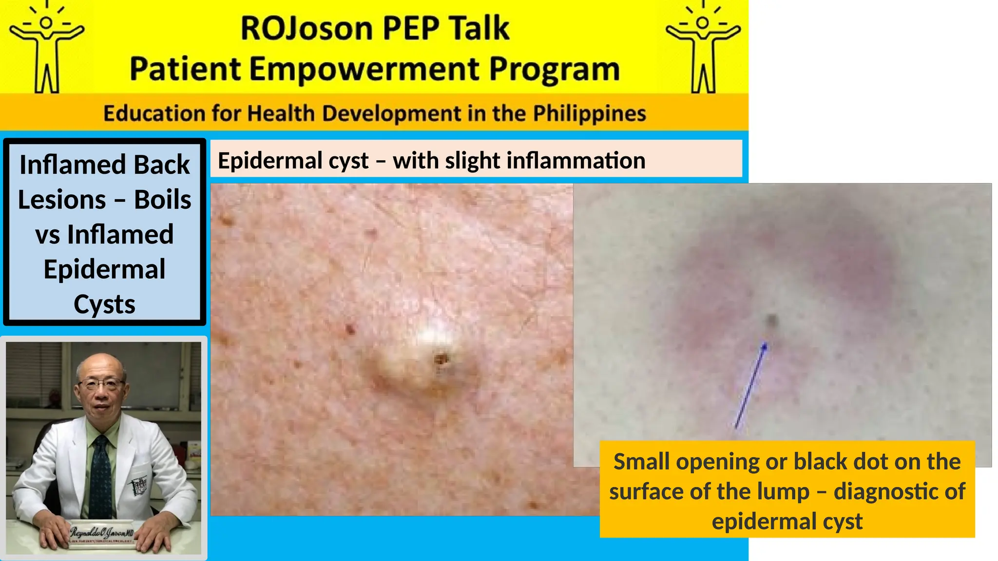 ROJoson PEP Talk: Inflamed Back Lesions: Boils vs Inflamed Epidermal ...