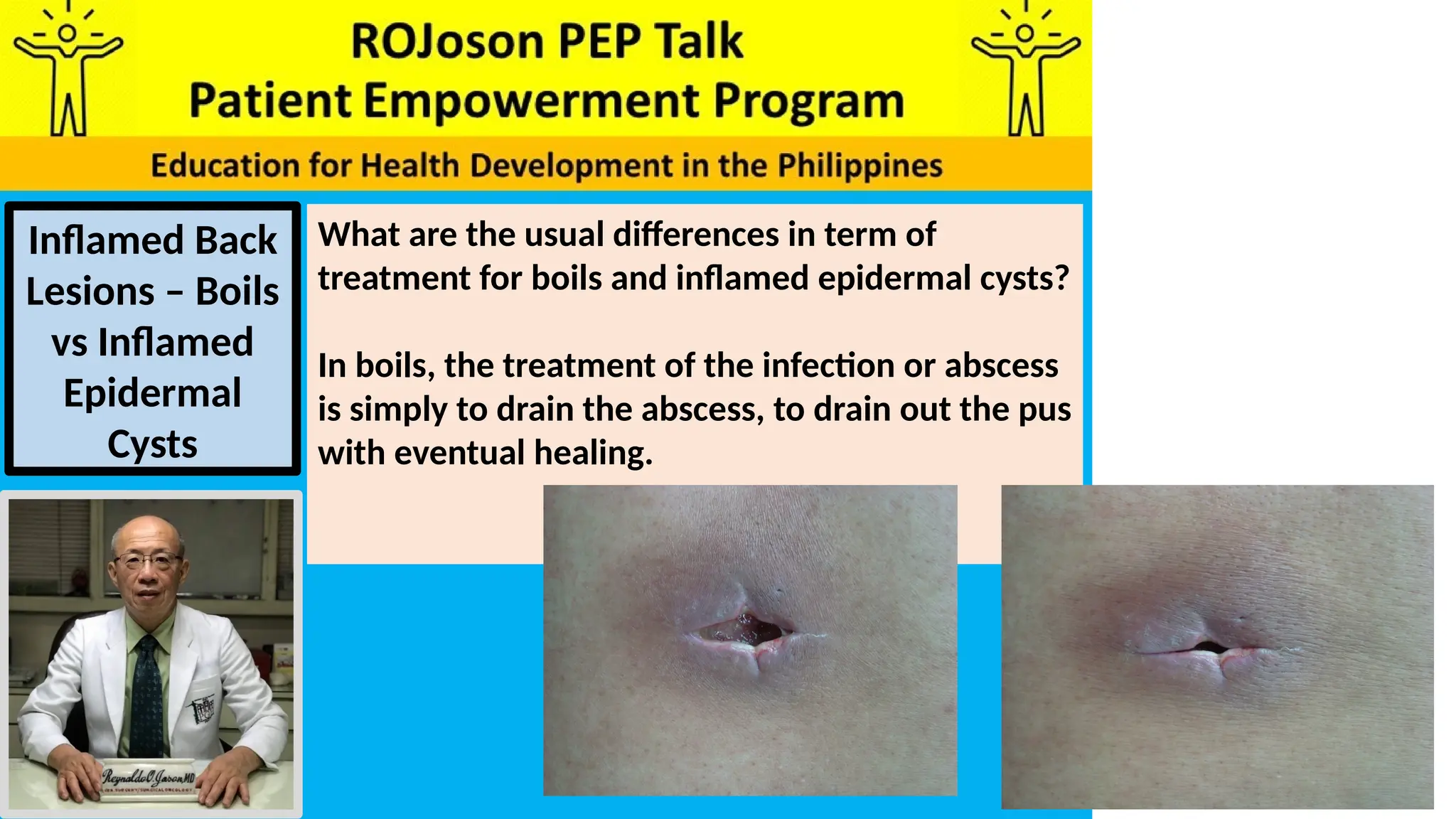 ROJoson PEP Talk: Inflamed Back Lesions: Boils vs Inflamed Epidermal ...