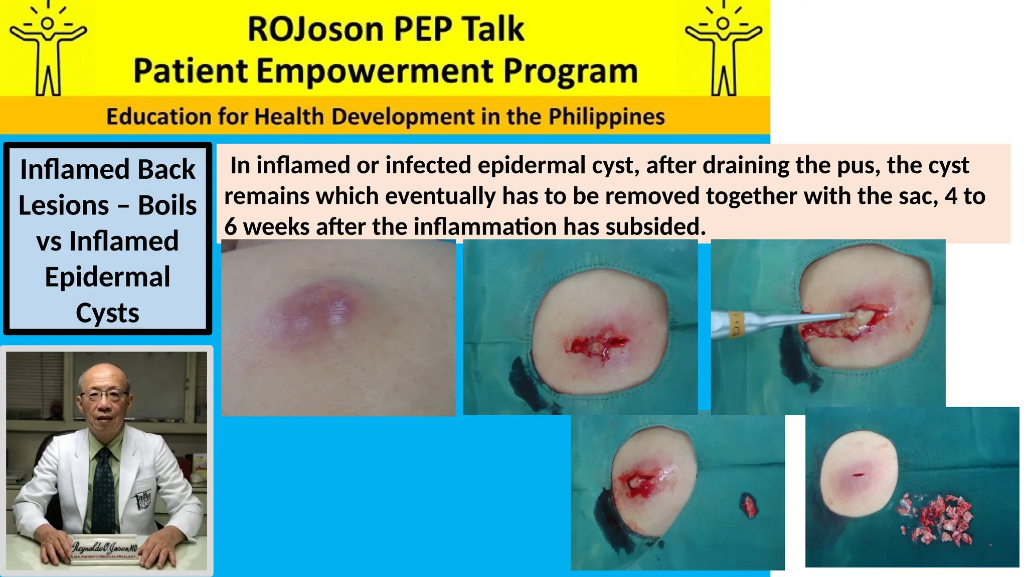 ROJoson PEP Talk: Inflamed Back Lesions: Boils vs Inflamed Epidermal ...