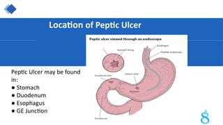 Peptic ulcer disease-2 (1) abdullah-2 (1).pptx