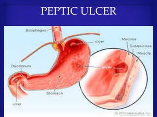 Peptic ulcer | PPTX