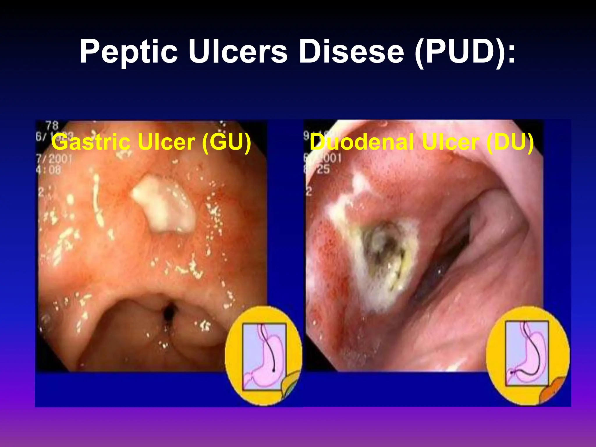 Peptic-Ulcer-Epidemiology-and-Social-Factor.pdf