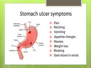 Peptic & Duodenal Ulcer.pptx