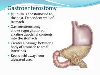 Teapot Stomach