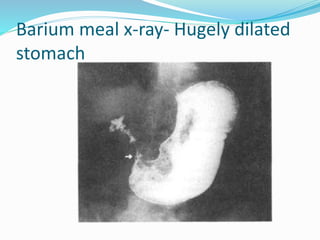 Teapot Stomach
