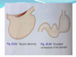 Teapot Stomach