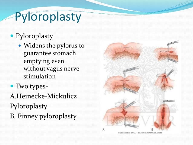 Benigne Diseases Of Stomach...