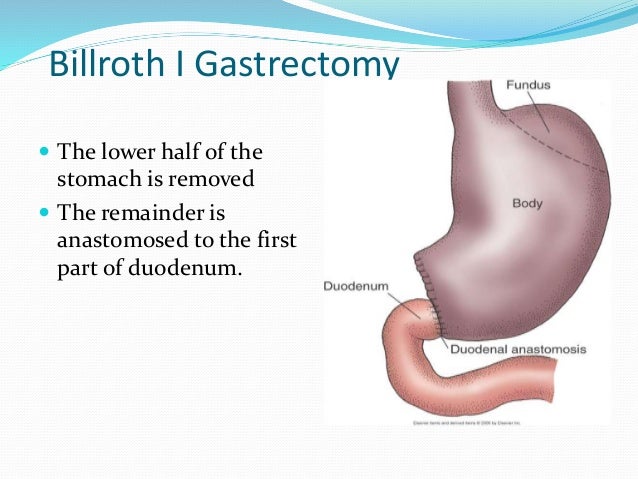 Benigne Diseases Of Stomach...