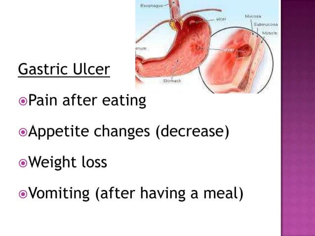 Peptic ulcer (Clinical features, Investigation and Management ...