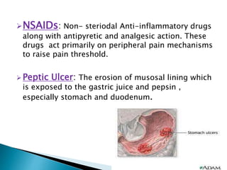 Peptic ulcer | PPT